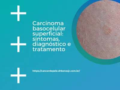 Carcinoma basocelular superficial: sintomas e tratamento – Especialista ...